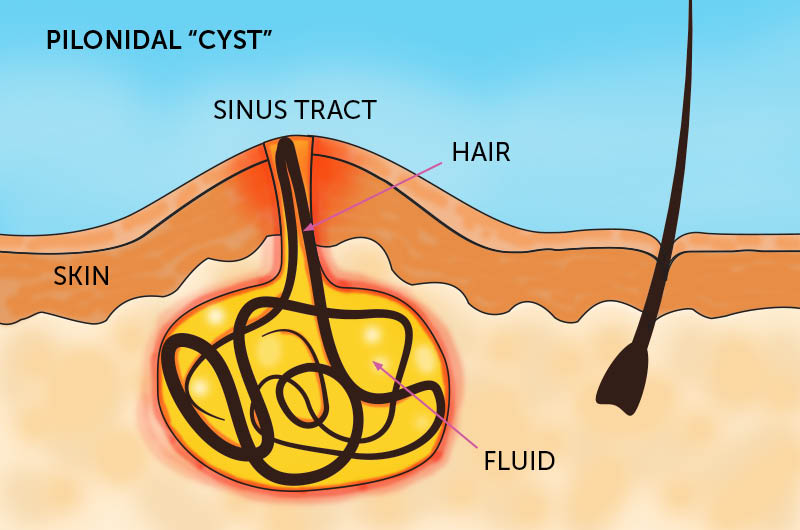 My experience of: Pilonidal Cyst/Abscess Surgery: Staphylococcus Aureus ...